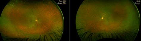 The Ods Guide To Identifying Peripheral Retinal Disease With Cheat Sheet