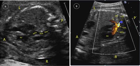 Right Aortic Arch And Isolated Left Subclavian Artery Prenatal And