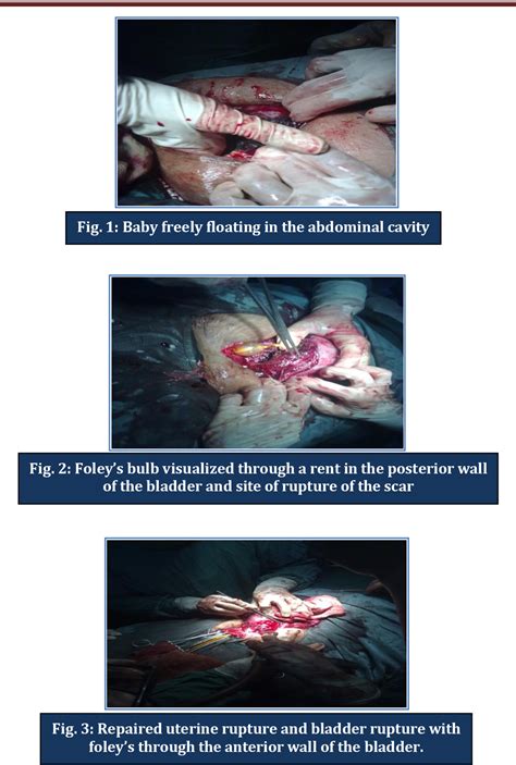 Figure 1 From Uterine Rupture With Simultaneous Bladder Rupture A Case
