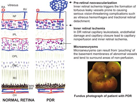 Pathogenesis Of Diabetic Retinopathy Dr Bm Bruchs Membrane Ch Download Scientific