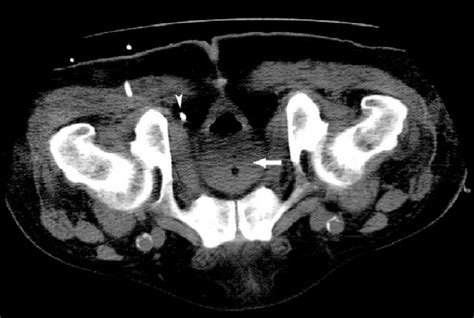 Pelvic Computed Tomography Reveals Marked Improvement Of The Prostatic