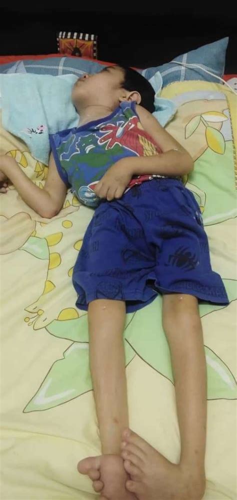 Clinical Photograph Showing Features Of Spasticity Leading To