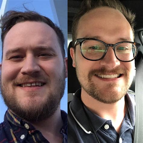 The Glow Up Second Time With Braces Was Well Worth It R Braces