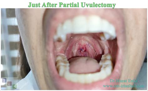 A Simple Partial Uvulectomy Technique Under Local Anesthesia For The
