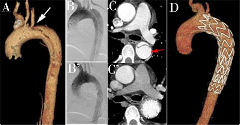 A Three Dimensional Computed Tomography Angiography Cta Is Shown In A