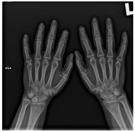 Imaging In Diagnosis Of Systemic Sclerosis Pmc