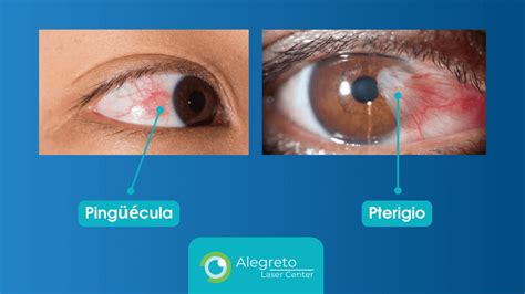 Pterigio Vs Pinguecula