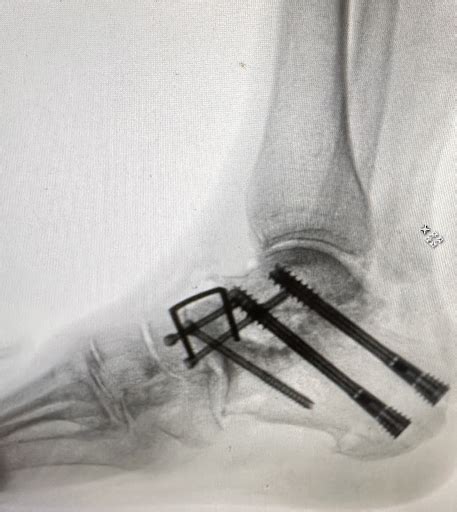 Subtalar Fusion Procedure Emergeortho Foothills Region