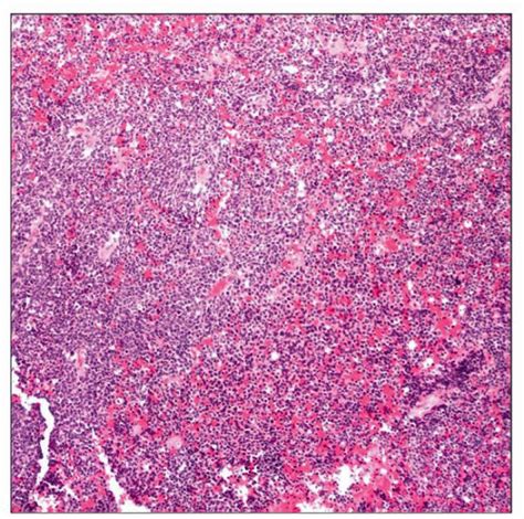 Peripheral Neuroepitheliomaprimitive Neuroectodermal Tumor