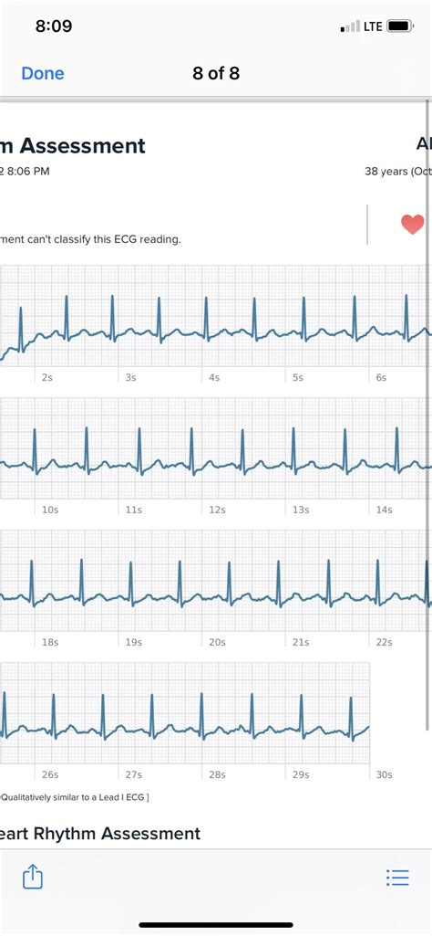 Ecg Reading Normal And Abnormal