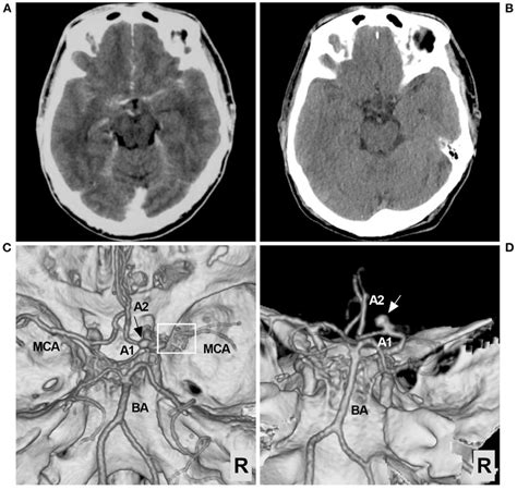 Figure E Preoperative Ct And Cta Images A Ct Showing The Extensive Download Scientific