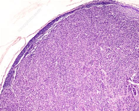 Carcinoma Metastasis To The Lymph Node Light Micrograph Stock Image C060 3321 Science