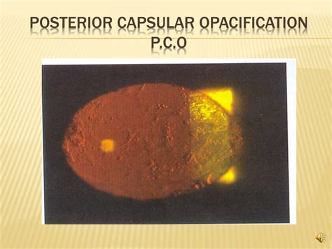 Ppt Posterior Capsular Opacification Pco Powerpoint Presentation