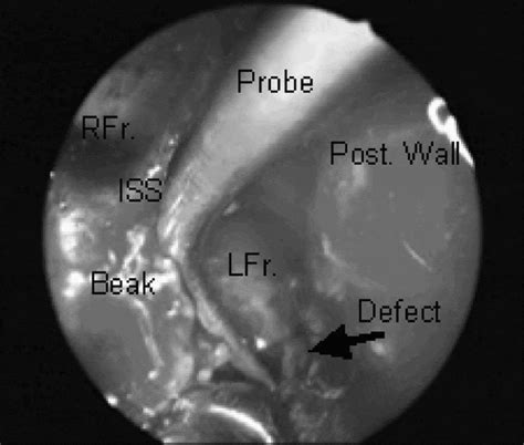 Endoscopic Modified Lothrop Procedure For Repair Of Lateral Frontal Sinus Cerebrospinal Fluid