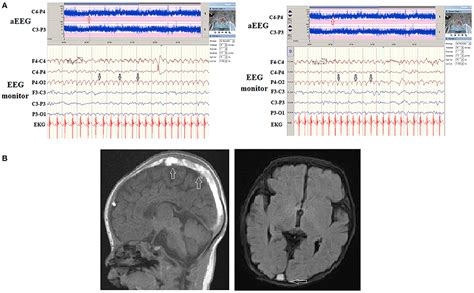 Frontiers Amplitude Integrated Electroencephalography And Continuous