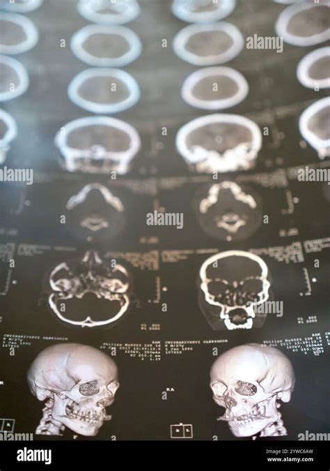 Mri Of The Human Brain Of A Patient With Multiple Sclerosis Of The