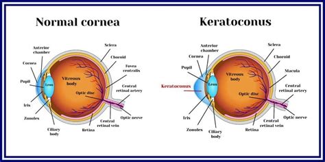 Does Keratoconus Ever Lead To Blindness Nvision