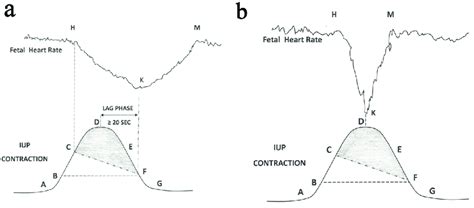 A Schematic Drawing Of Fhr Deceleration Resulting From Peripheral Download Scientific Diagram A Schematic Drawing Of Fhr Deceleration Resulting From Peripheral Download Scientific Diagram