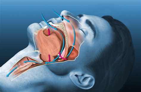 Sleep Apnea Causes Symptoms And Treatment Options