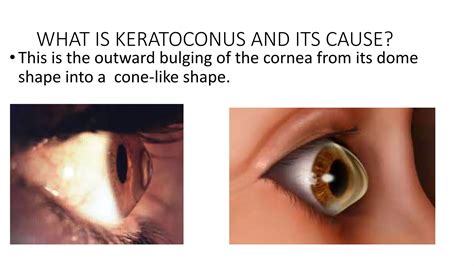 Corneal Cross Linking Pptx Eye And Vision Conditions Diseases And