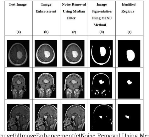 Figure 1 From Brain Tumor Segmentation Using Threshold Method Semantic Scholar