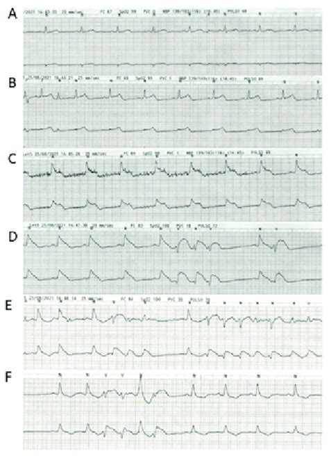 Two Lead Ecg Continuous Monitoring Showing Sequential Phases Of Silent Download Scientific