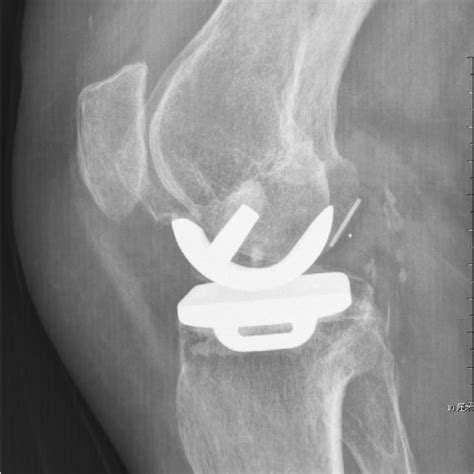 pdf the learning curve for minimally invasive oxford phase 3