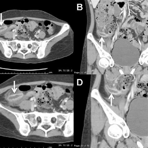 Ct Abdomen Demonstrates A Thickened And Enhanced Wall Vermiform Download Scientific Diagram