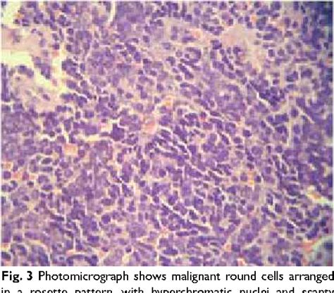 Figure 3 From Peripheral Type Of Primitive Neuroectodermal Tumour Arising From The Left Orbital
