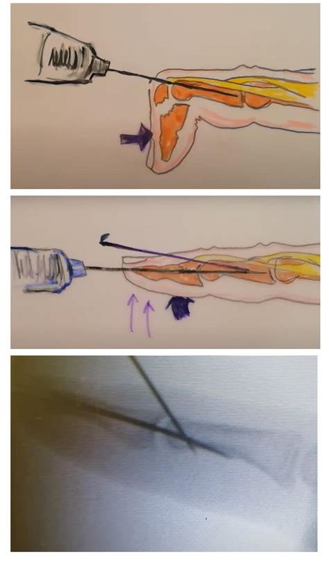 Mallet Finger Bullets At Sophie Clarkson Blog