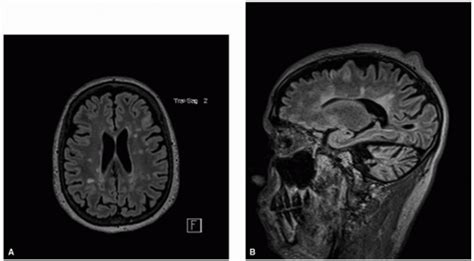 Lower Extremity Signs And Symptoms Of Multiple Sclerosis Musculoskeletal Key