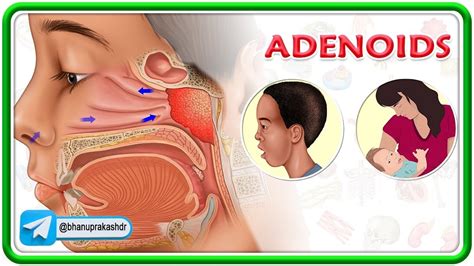 Adenoid Facies Clinical Features