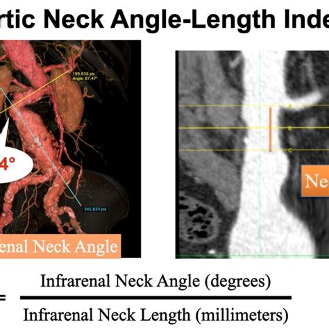 Five Year Overall Survival Rate Between Aortic Neck Angle Length Download Scientific Diagram