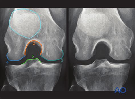 Intercondylar Fossa X Ray