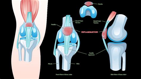 Effective Strategies For Runners Knee Pain Dr Eric Giang