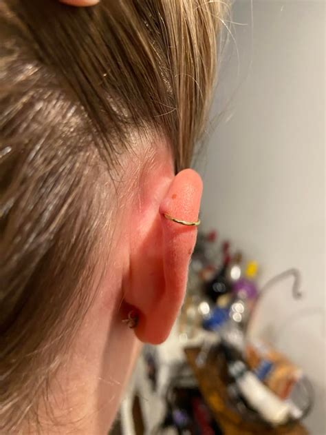 Keloid Or Irritation Bump Rpiercinghelp