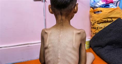Unicef Alerta De Los Niveles Devastadores De Desnutrición Infantil En Gaza En Plena Ofensiva