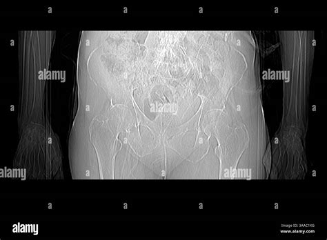 Computed Tomography Of A Grandmother After A Fall With Osteoporosis And