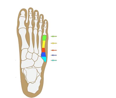 Jones 5th Metatarsal Base Fractures Atlanta Bone And Joint Specialists