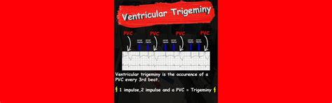 Ventricular Trigeminy Ems Cardiology Lights Sirens Action Ems