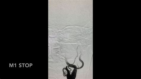 Willem Jan Van Rooij On Linkedin Simple And Quick Thrombectomie Using Sofia 6f Az Turnhout