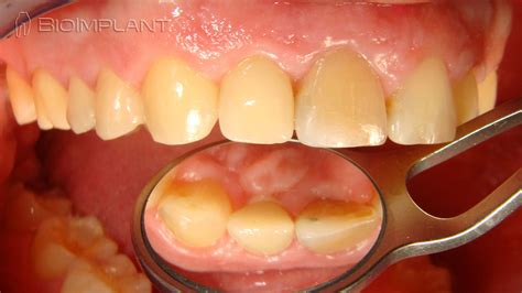 The Fractured Right Lateral Incisor Has Been Replaced With An Immediate