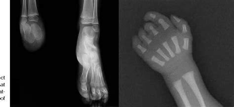 Figure 1 From Association Of Hereditary Thrombocythemia And Distal Limb