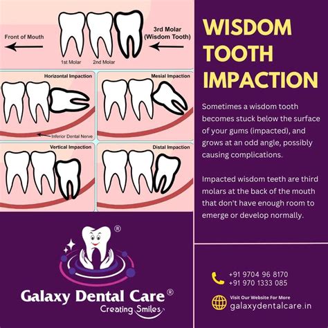 Wisdom Tooth Impaction Impacted Wisdom Teeth Wisdom Teeth Impaction