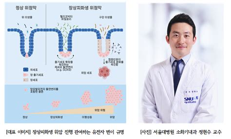 만성 위염 장상피화생 위암 진행 관여하는 유전자 변이 규명 약품신문