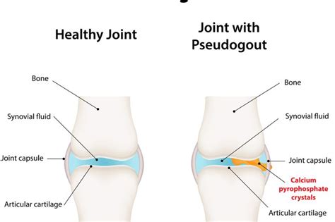 Symptoms And Treatments Of Chondrocalcinosis Health And Detox And Vitamins