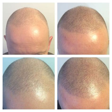 What You Need To Know About Smp Scalp Micropigmentation And Hair