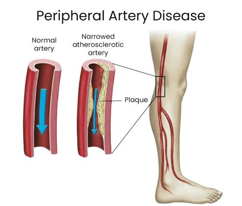 Peripheral Artery Disease Treatments In Brooklyn