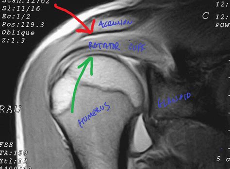 The Difference Between External And Internal Impingement Of The