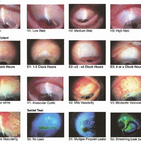 Photographic Standards Of The Indiana Bleb Grading Scale For Height
